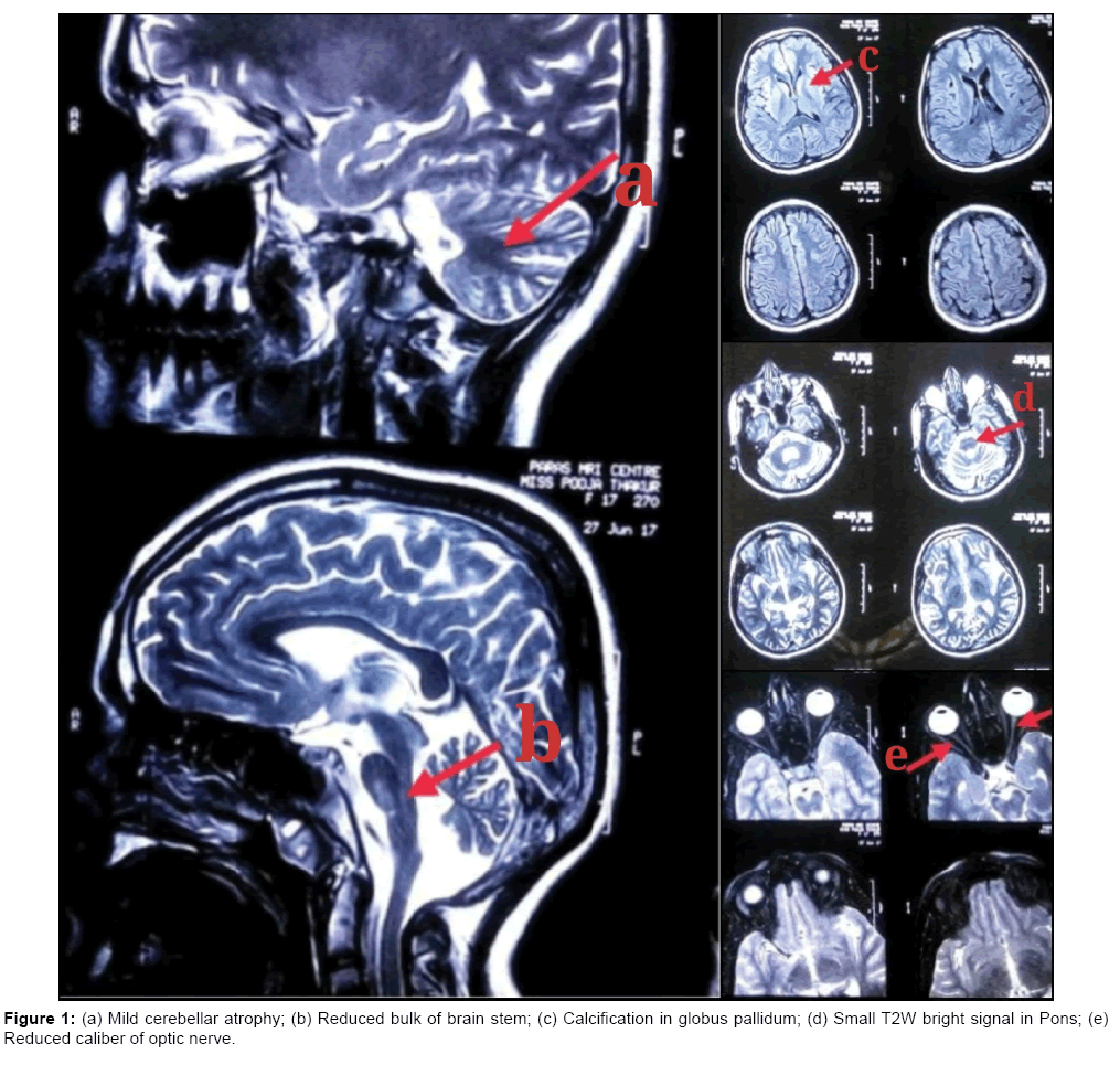 Wolfram Syndrome with Non-Symptomatic Neurodegenerative Changes-